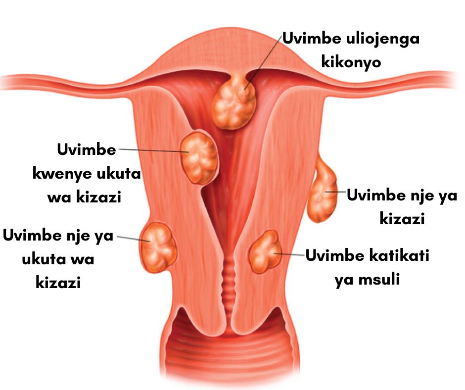 Je, Ni Ukubwa Gani Wa Uvimbe Wa Fibroid Unaweza Kuwa Hatari Kwako ...
